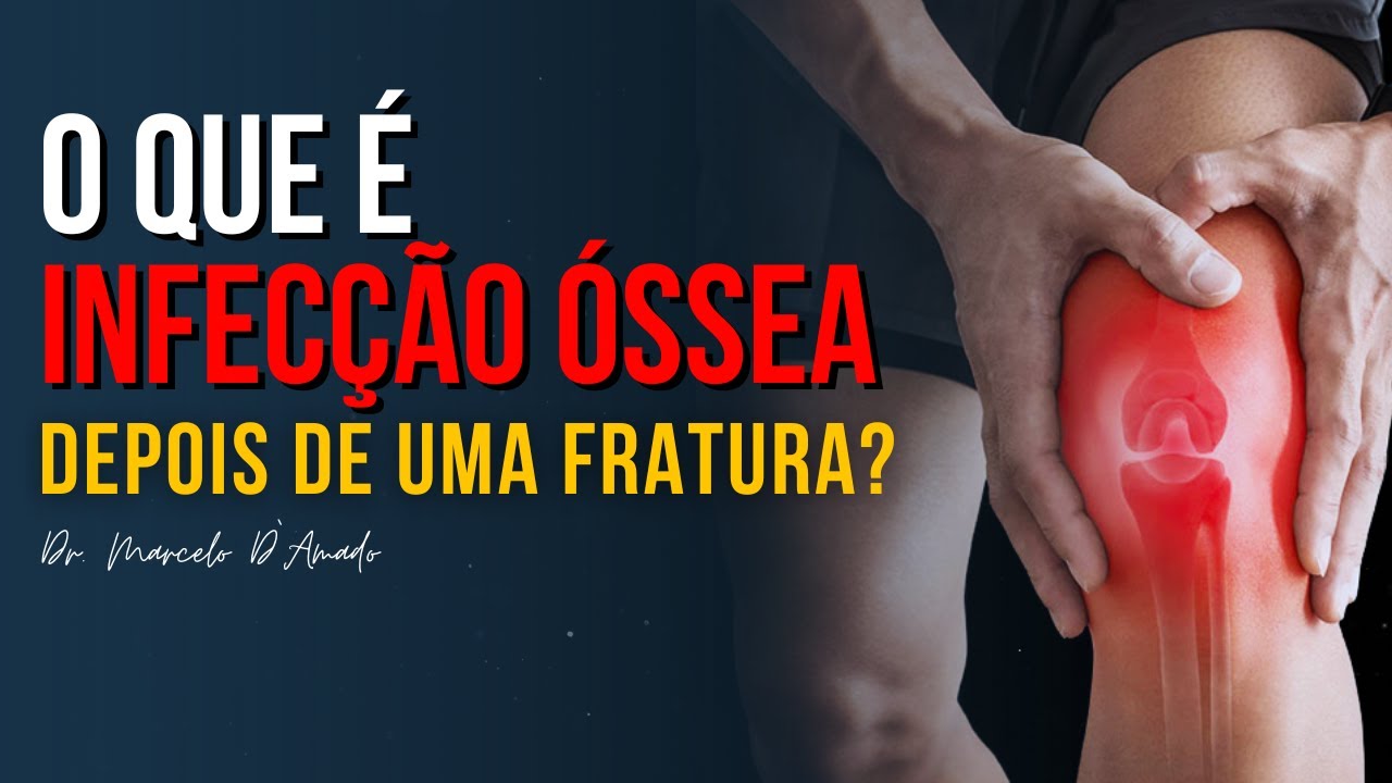 OSTEOMIELITE | O QUE É INFECÇÃO ÓSSEA DEPOIS DE UMA FRATURA? - YouTube