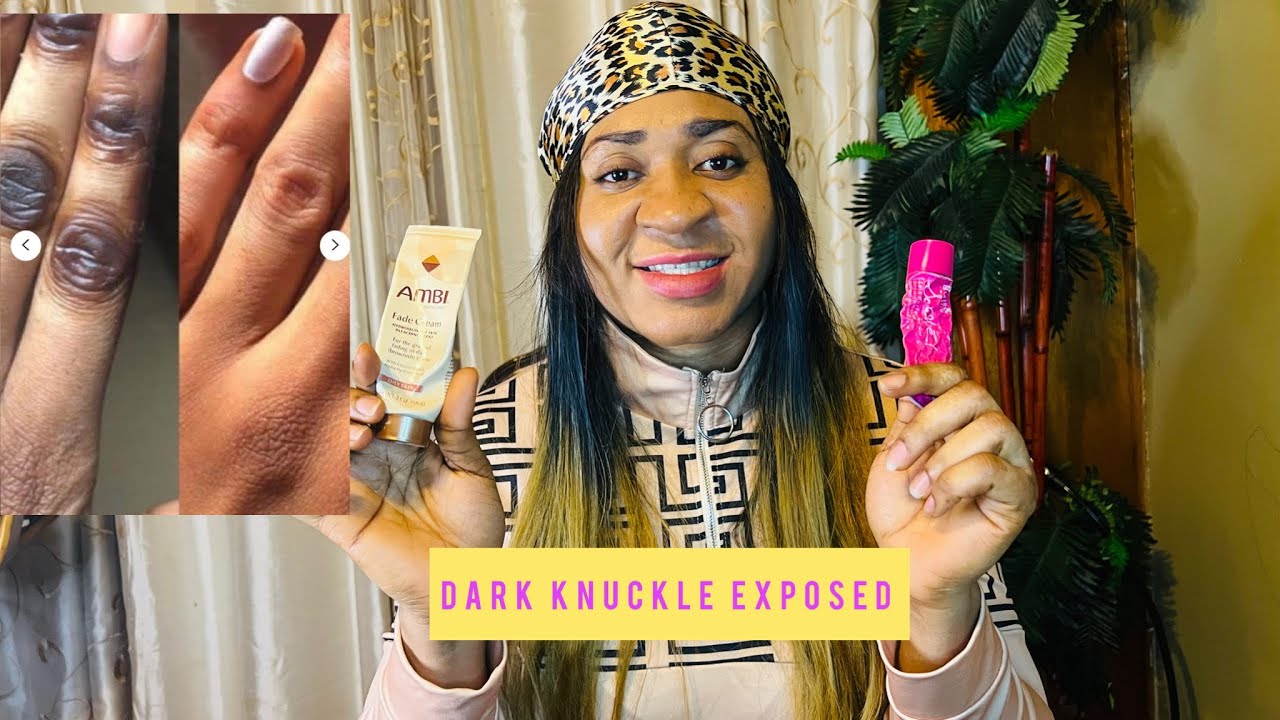 How to Get Rid of Dark Knuckles |Hyperpigmentation| Dark spots| Dark ...