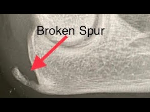 Elbow - Fractured Olecranon Spur (Painful Non-Union) - YouTube