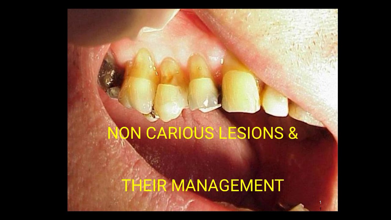 Non carious cervical lesions part 1 - YouTube