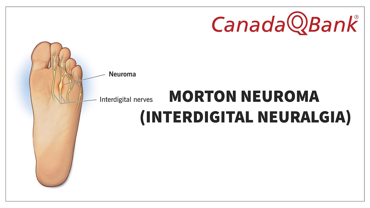 Morton Neuroma (Interdigital Neuralgia) - YouTube