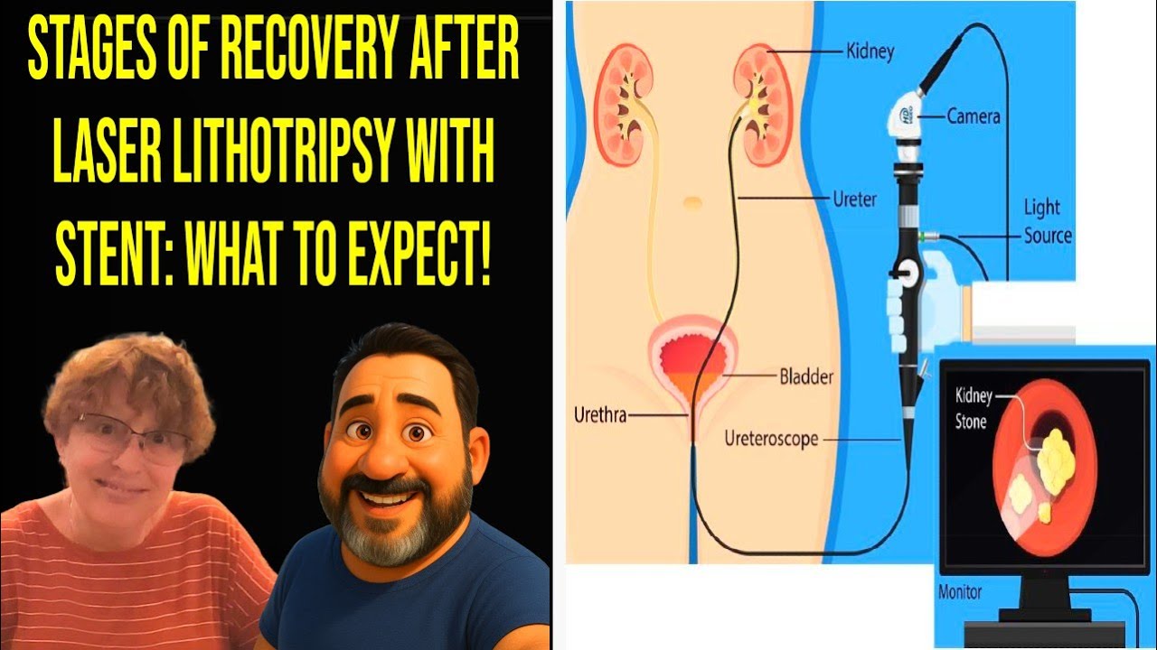 Ureteroscopy & Laser Lithotripsy, Stent Recovery: Tips I Wish I Knew ...