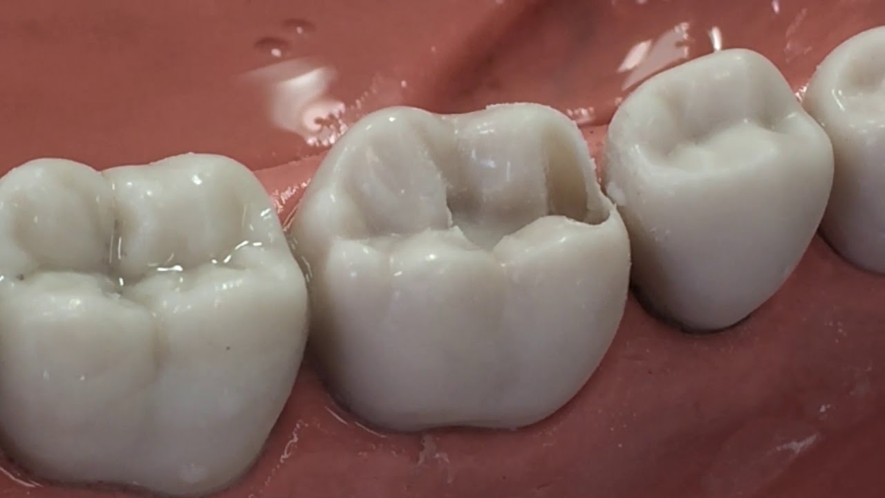Class II cavity preparation: Molar - YouTube