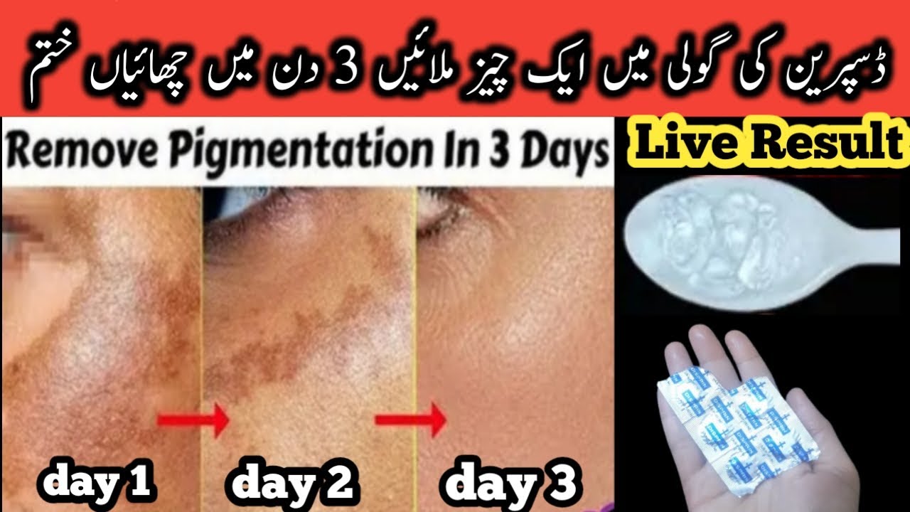 Disprin Tablet for Skin Pigmentation and Anti acne | How To Remove ...