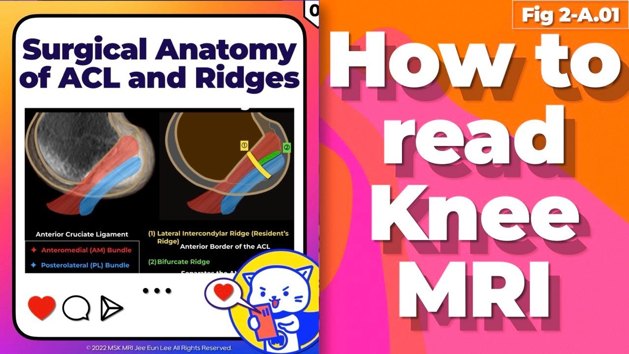 (Fig 2-A.01) Surgical Anatomy of ACL and Associated Ridges - YouTube