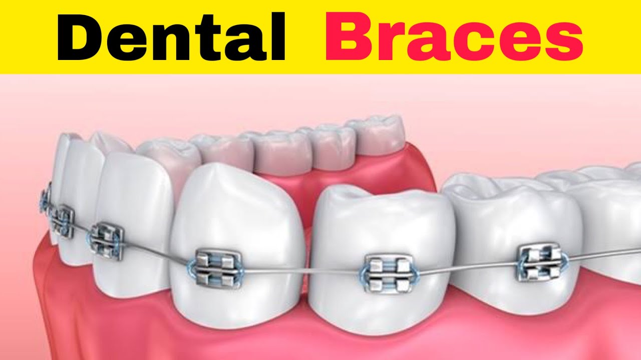 Dental Braces Animation - YouTube