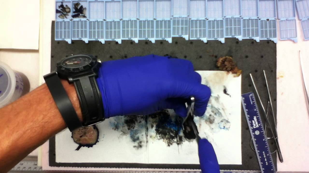 Grossing Radical Prostate - YouTube