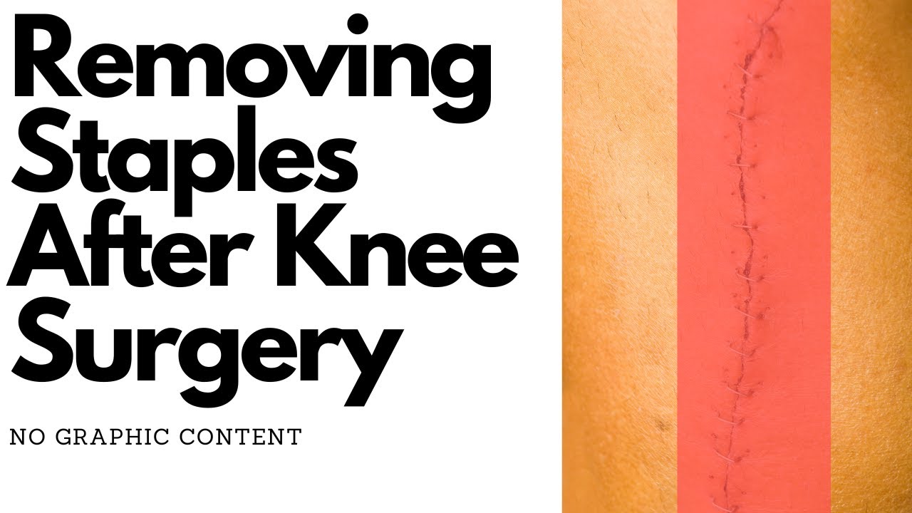 Staple Removal After Total Knee Replacement YouTube staple-removal-after-total-knee-replacement-youtube