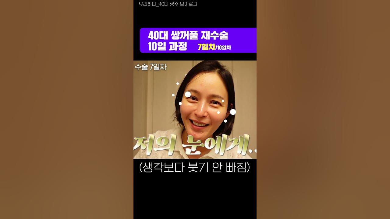 40대 쌍꺼풀 재수술 할까 말까 쌍꺼풀재수술 쌍꺼풀수술후기 Youtube