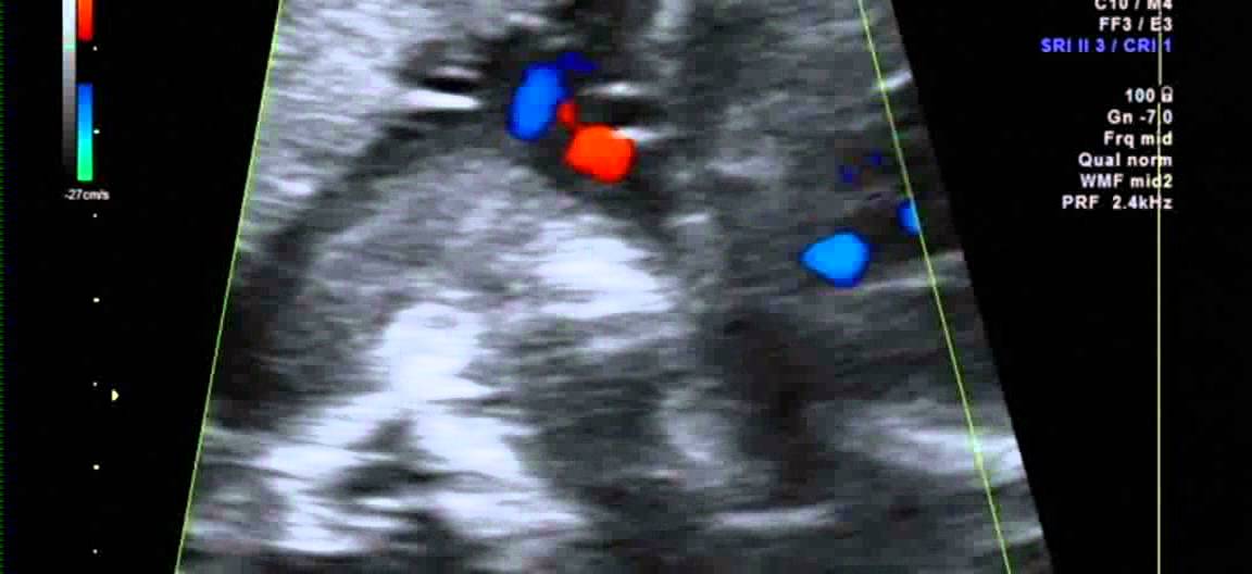 USG 20 w 3 d Ultramedica wykonane przez Lek med Anna Totkompeg4 - YouTube