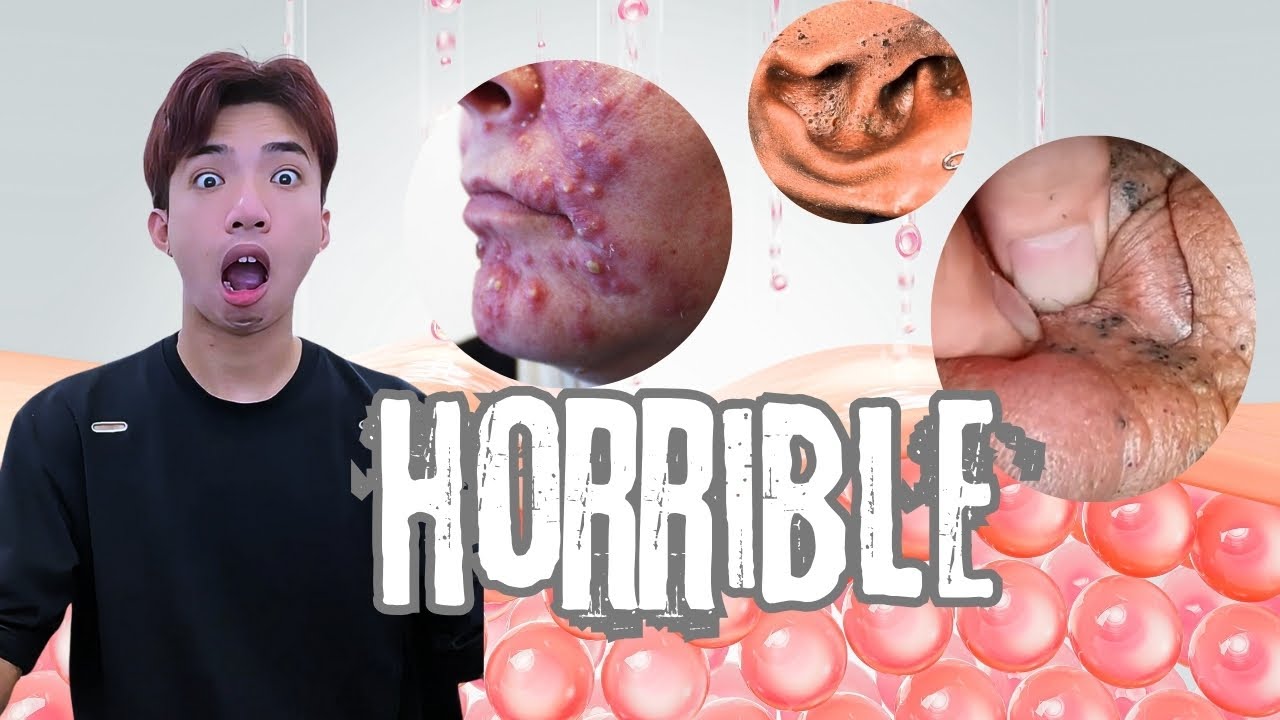 The Scariest Pimple Popping Videos You've Ever Seen! #3 - YouTube