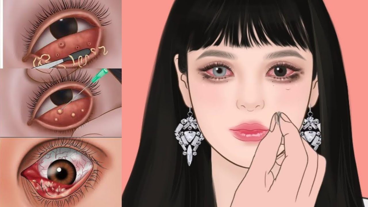 ASMR Eyelid Sebum Extrusion Animation / Extracting a Milia under the ...