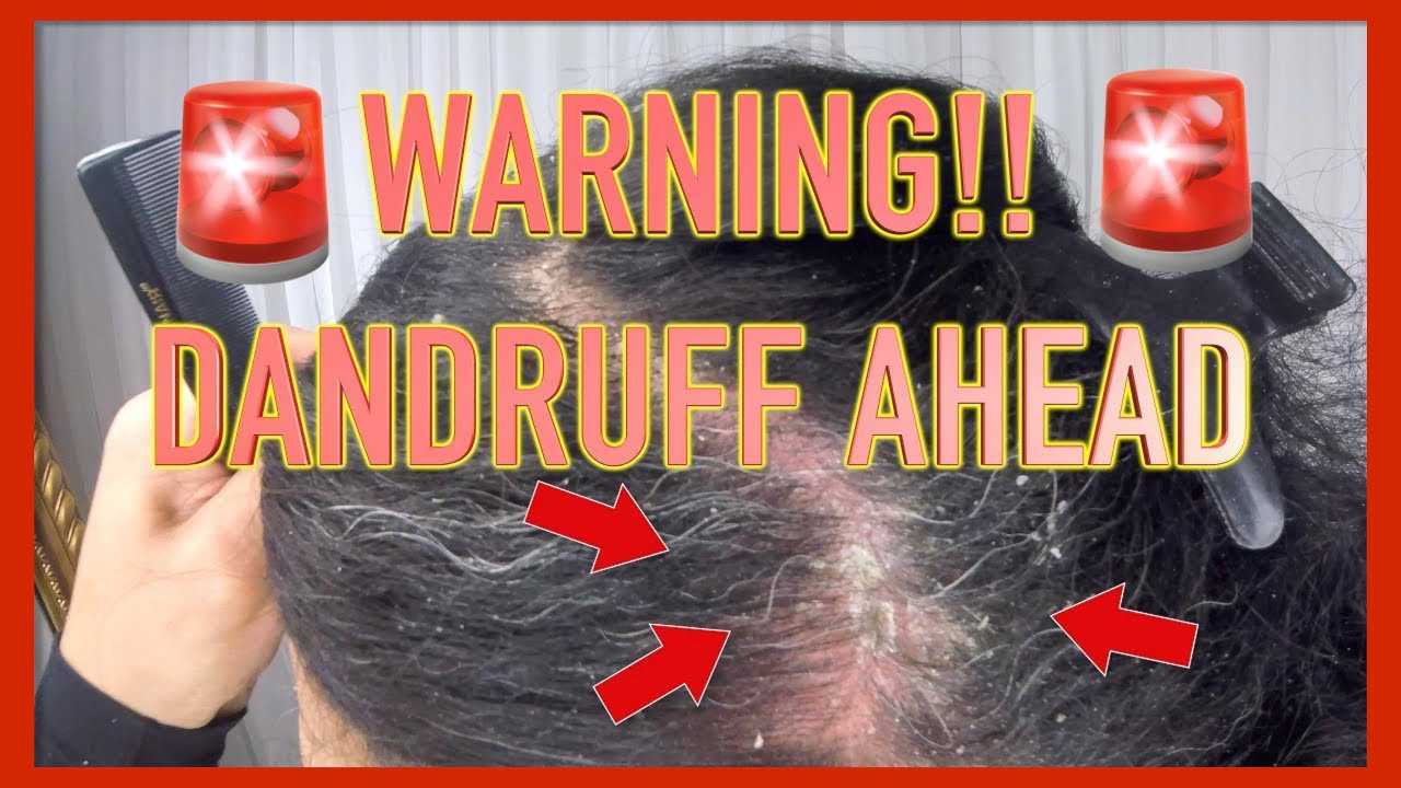 Dandruff Scratching and Combing part1 - YouTube