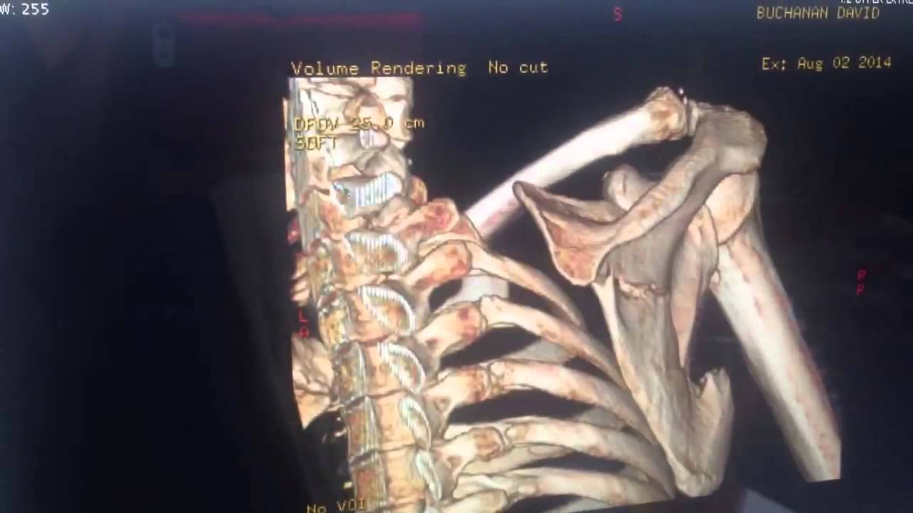 3D Animation of CT Scan - YouTube
