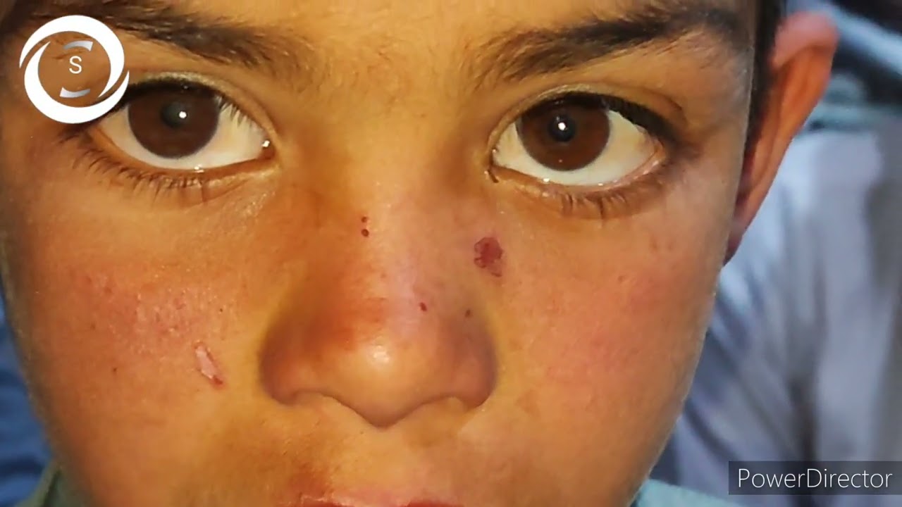 Hirschberg Corneal Reflection Test - YouTube