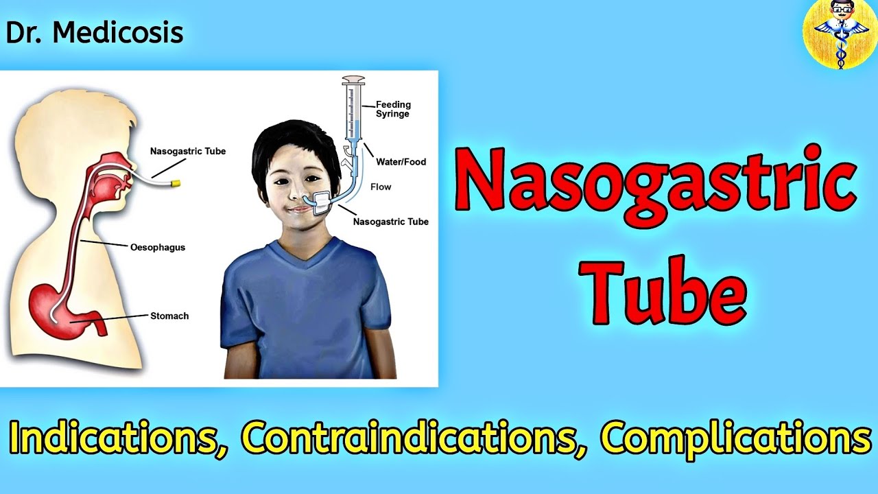 Nasogastric Tube | Indications | Contraindications, Complications | Dr ...