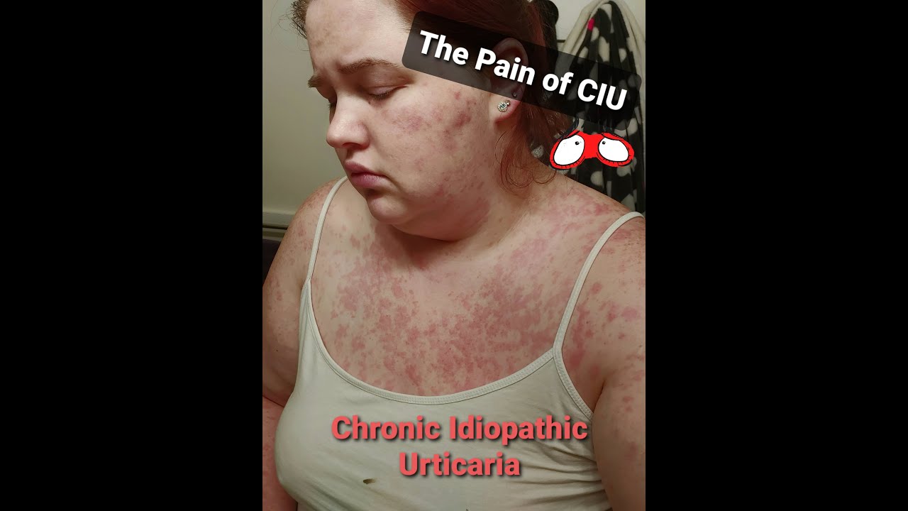 I have CIU - Chronic Idiopathic Urticaria - YouTube