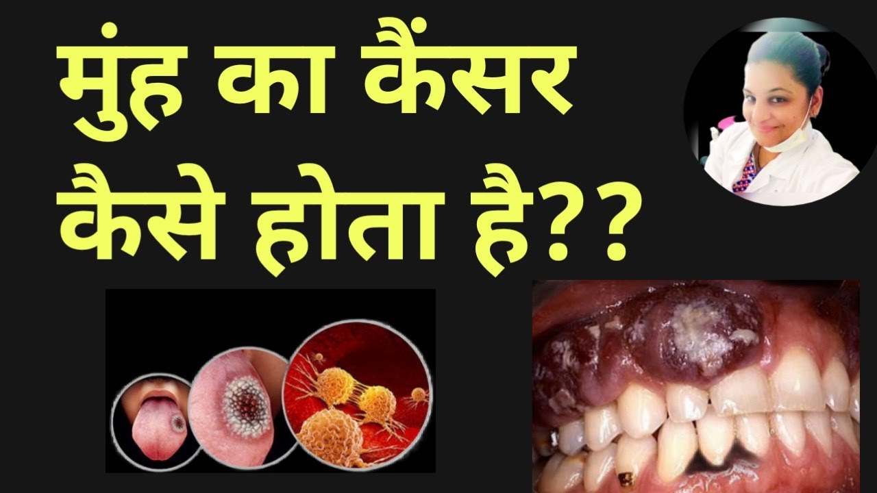 Muh ka cancer kaise hota hai? Tambaku, gutka khane se kya hota hai ...