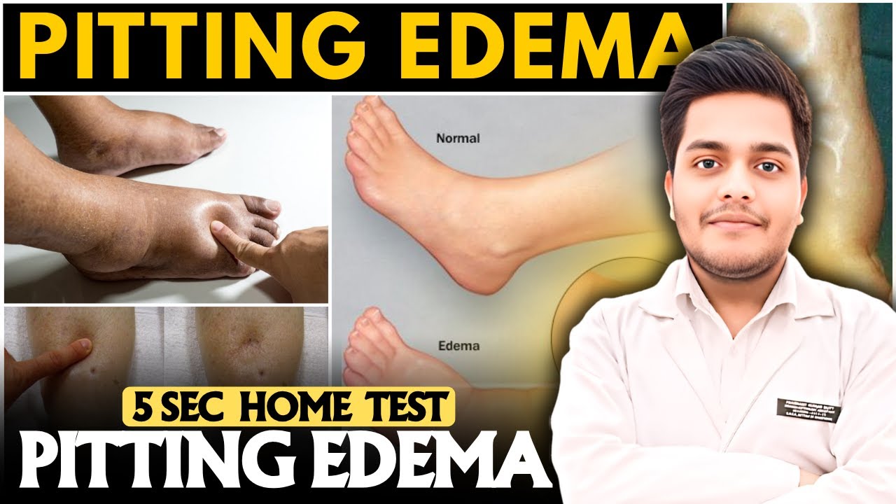 4 Things You're Doing Wrong That Make Pitting Edema Worse - YouTube