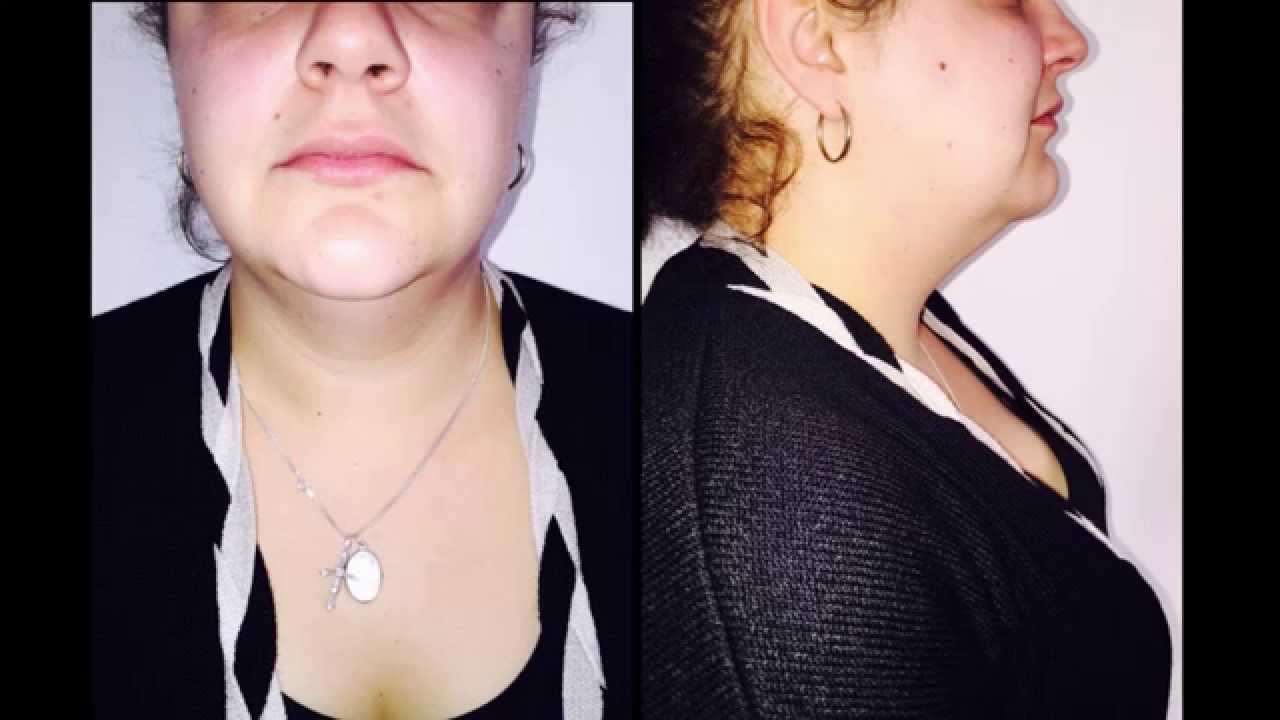 Neck Liposuction | London Lipo Institute - YouTube