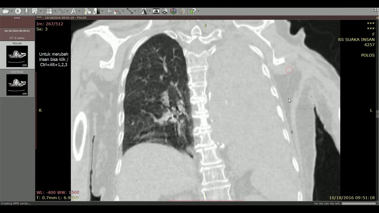 PENGGUNAAN DICOM VIEWER PADA CT LUNG TB - YouTube
