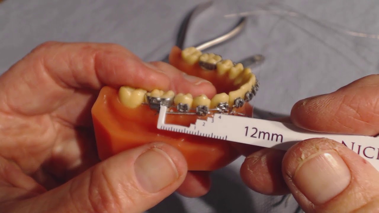 Niti closing coil, installation and activation - YouTube