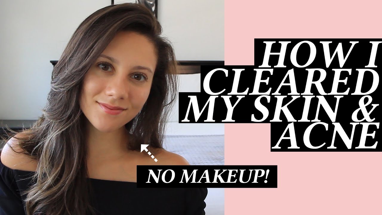 How I Cleared My Skin Acne Milia My Journey To Clear Skin Youtube