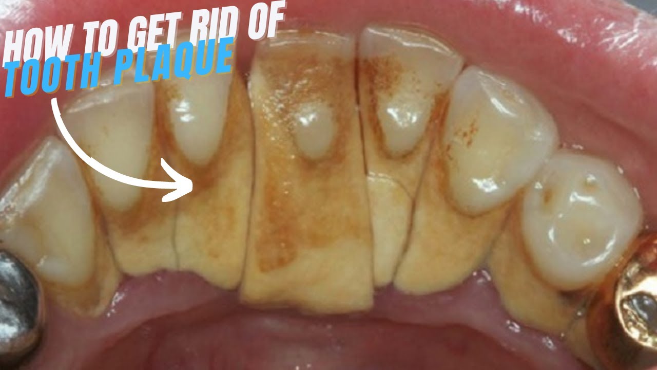 Massive Giant Teeth Tartar Removal Get Rid of Hard Plaque on Teeth #02 ...