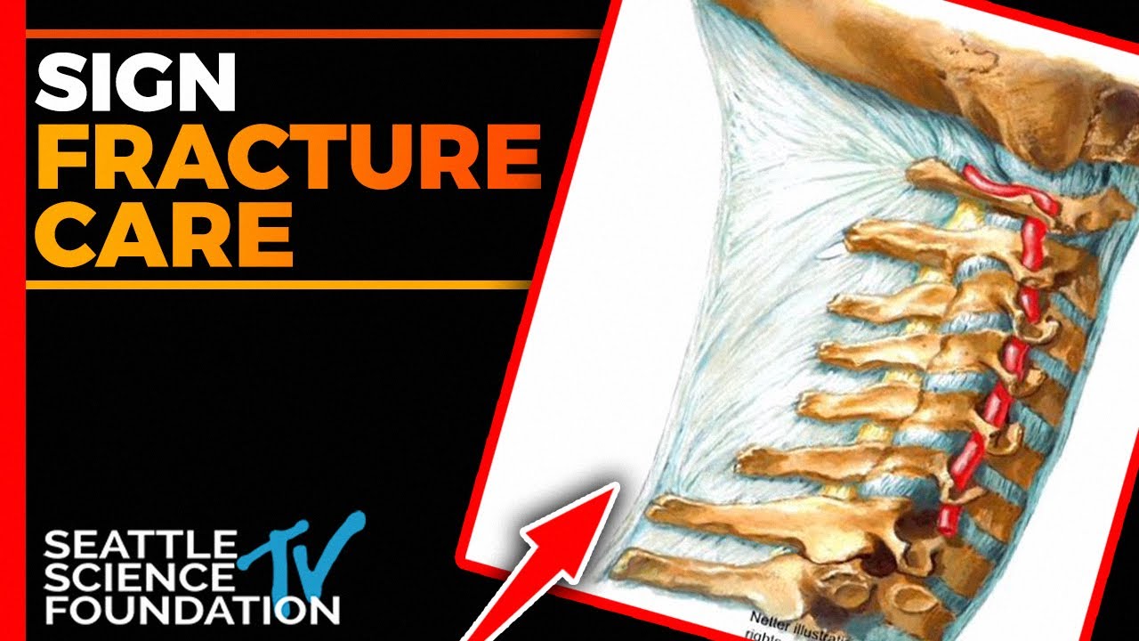 SIGN Fracture Care: Hands-on Cadaveric Course - YouTube