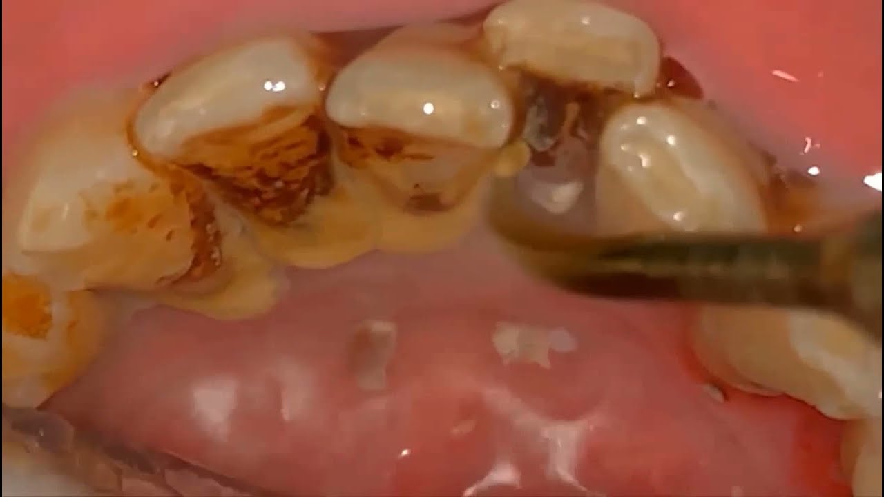 Heavy Calculus Tartar Removal - Dental Calaculus Removed with ...