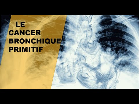 RESUME : Le cancer Bronchique Primitif : symptômes, Causes , diagnostic ...