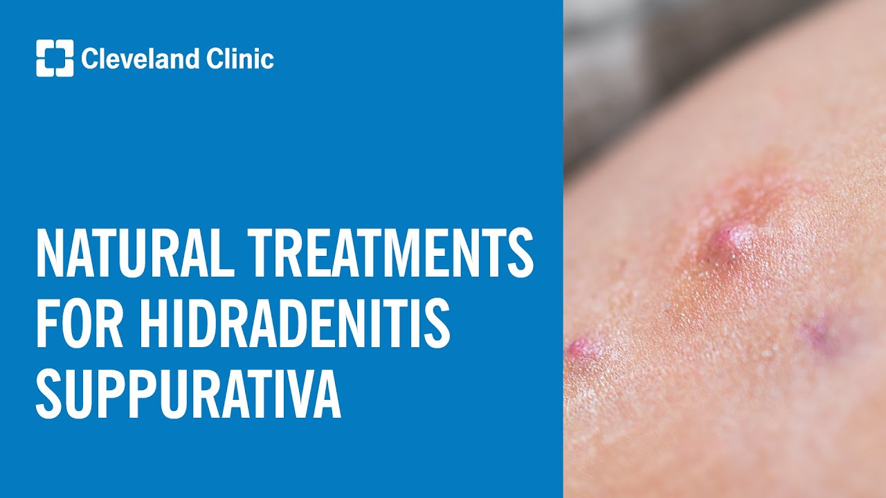 Natural Treatment Options for Hidradenitis Suppurativa - YouTube