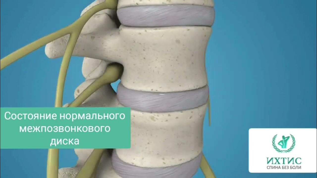 Что такое грыжа в пояснице. - YouTube