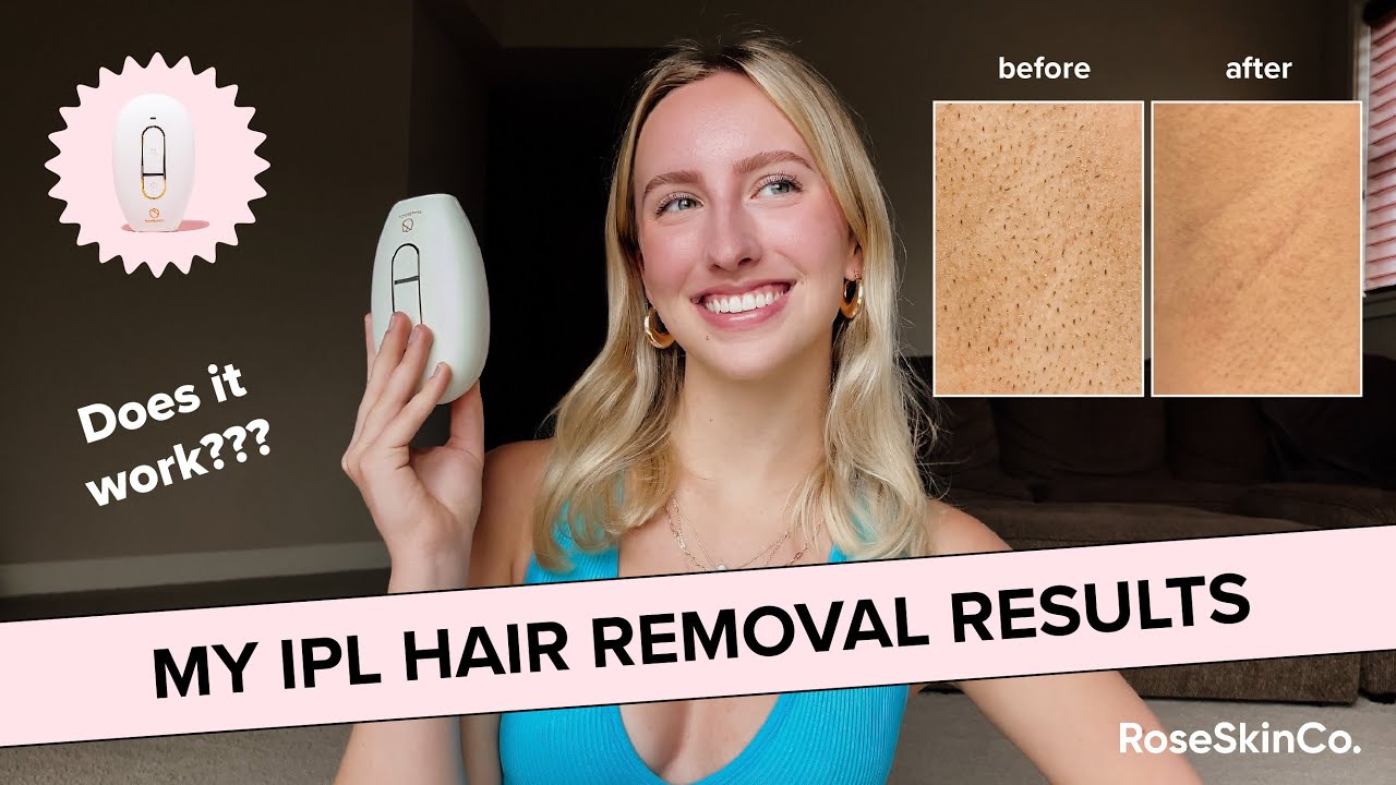 Lumi LASER HAIR REMOVAL Review & 1 Month Results! (ft. RoseSkinCo ...