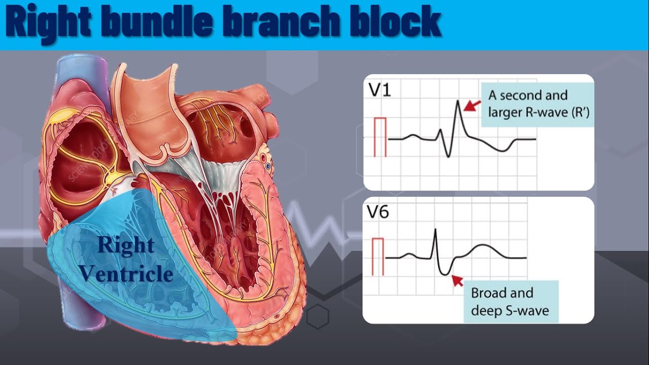 right bundle branch block | 3 ECG examples for RBBB | how to diagnose ...