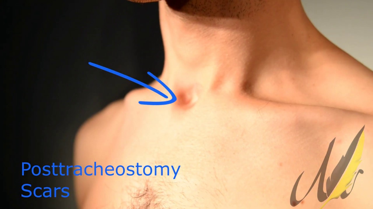 Trakeostomi izi onarımı (Tracheostomy scar correction) - YouTube