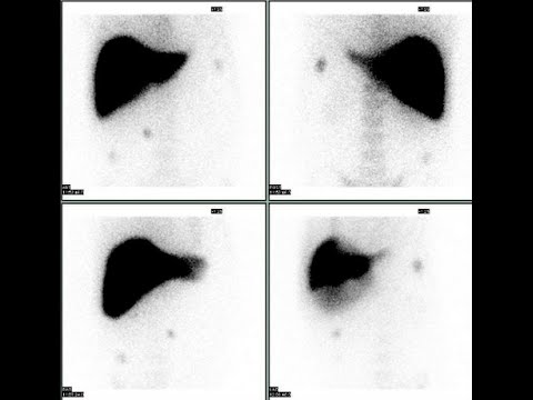 Nuclear Medicine Liver Spleen Scan - YouTube