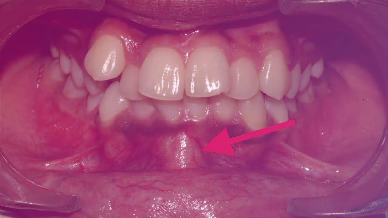 Surgical Extraction of Impacted Mandibular Canine - YouTube