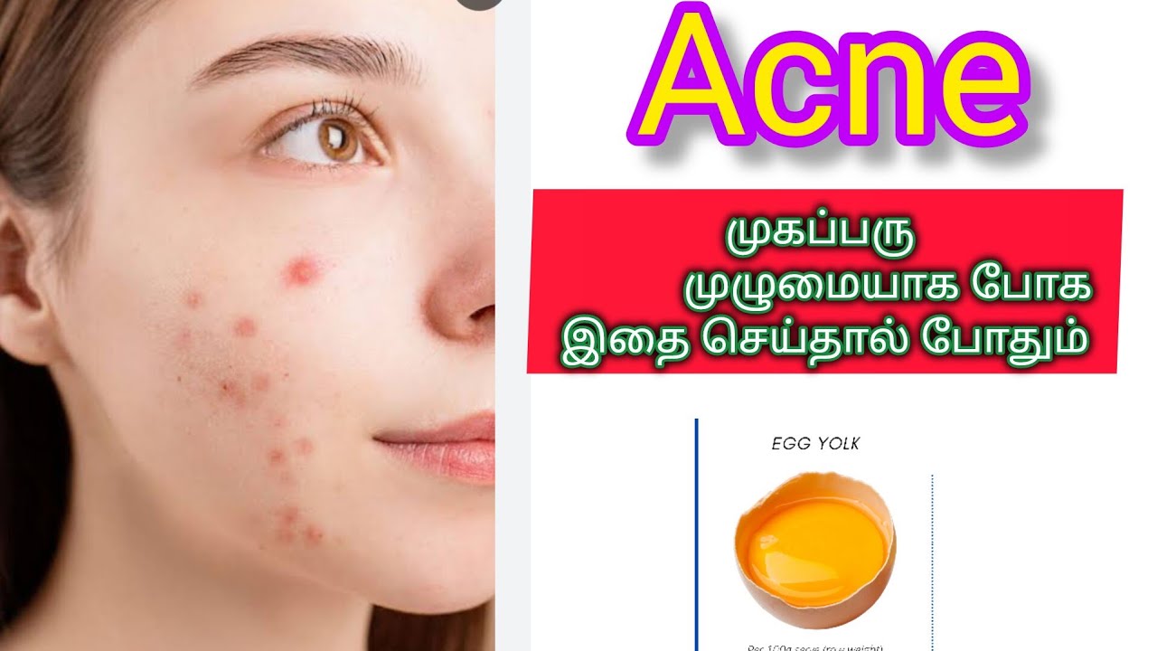 முகப்பரு உடனே மறைய | How to Remove pimples from face in Tamil |mugaparu ...
