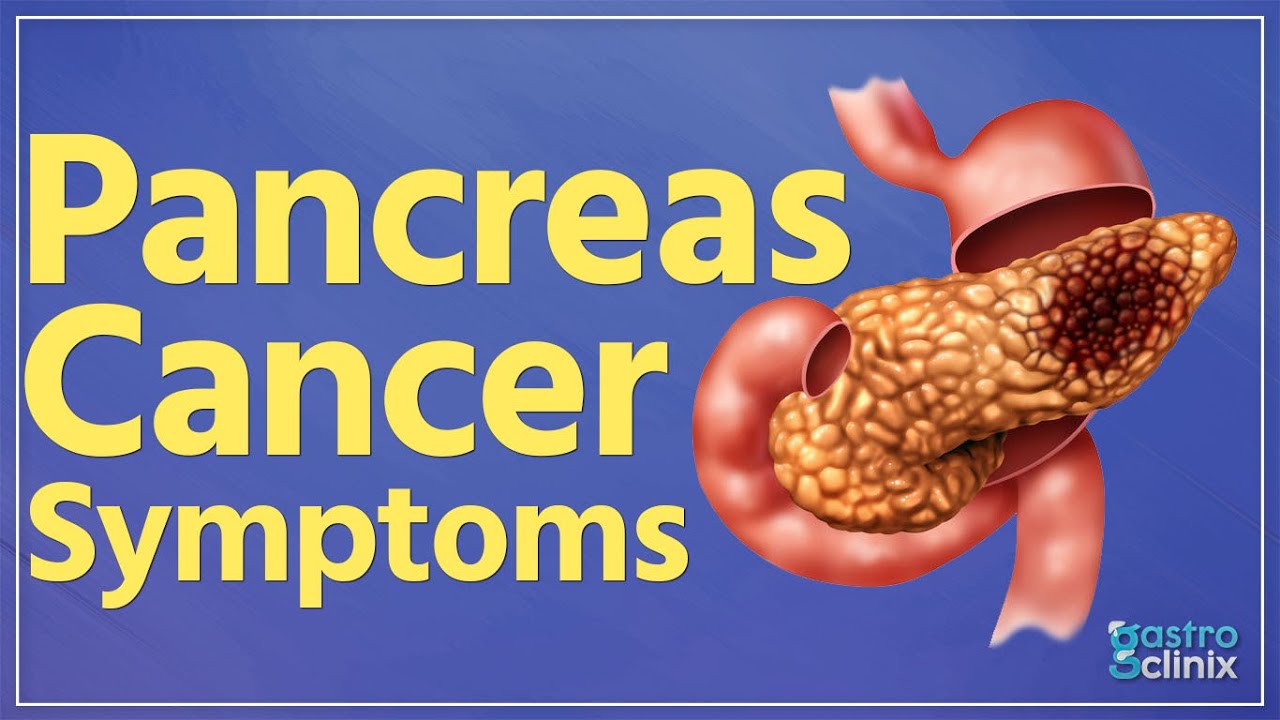 What are the symptoms of pancreas cancer ? - YouTube