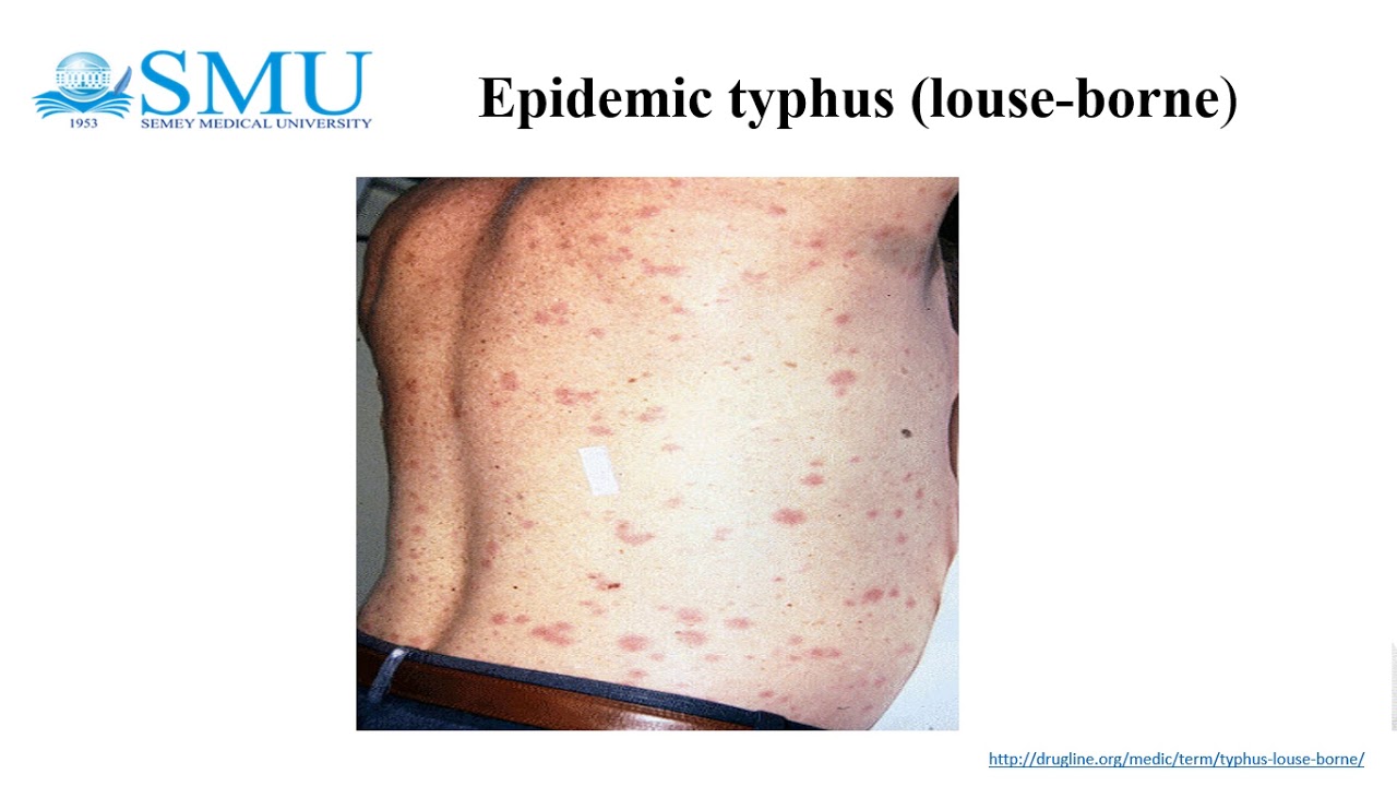 №12 Rickettsia Borrelia - YouTube