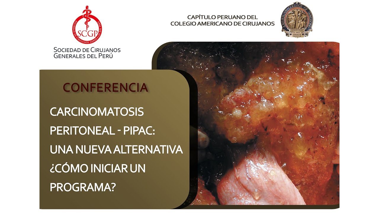 CARCINOMATOSIS PERITONEAL PIPAC: UNA NUEVA ALTERNATIVA ¿CÓMO INICIAR UN ...