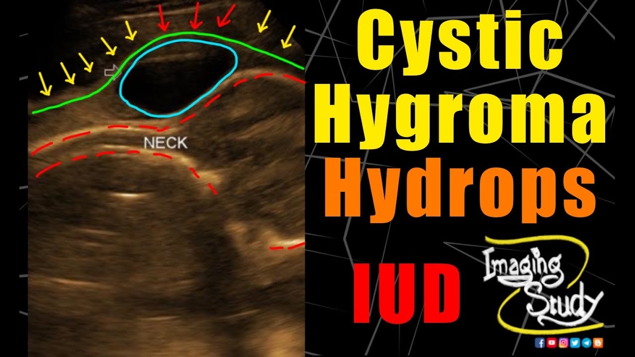 Hydrops Cystic Hygroma