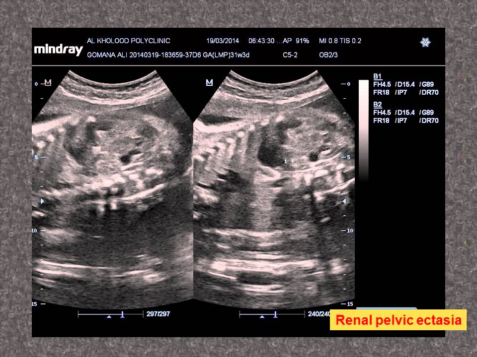 Case 47 Fetal Renal Pelvic Ectasia Dr AHMED ESAWY - YouTube