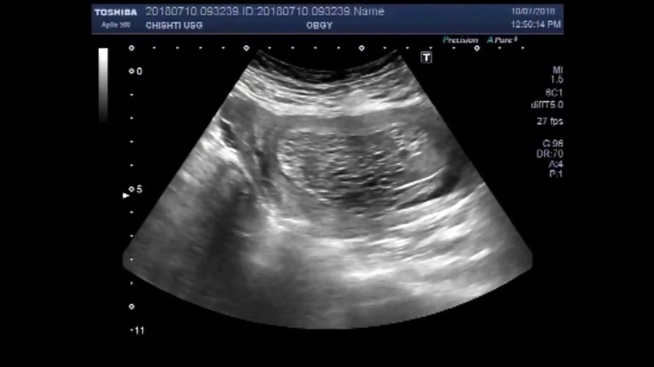 Ultrasound Video showing a Hydatidiform mole also called Molar ...