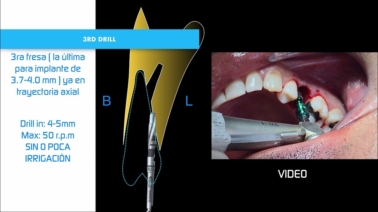 TRAILER POST EXTRACTION IMPLANT PLACEMENT DRILLING PROTOCOL Dental ...