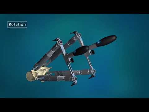 Orthofix. Firebird Deformity - YouTube