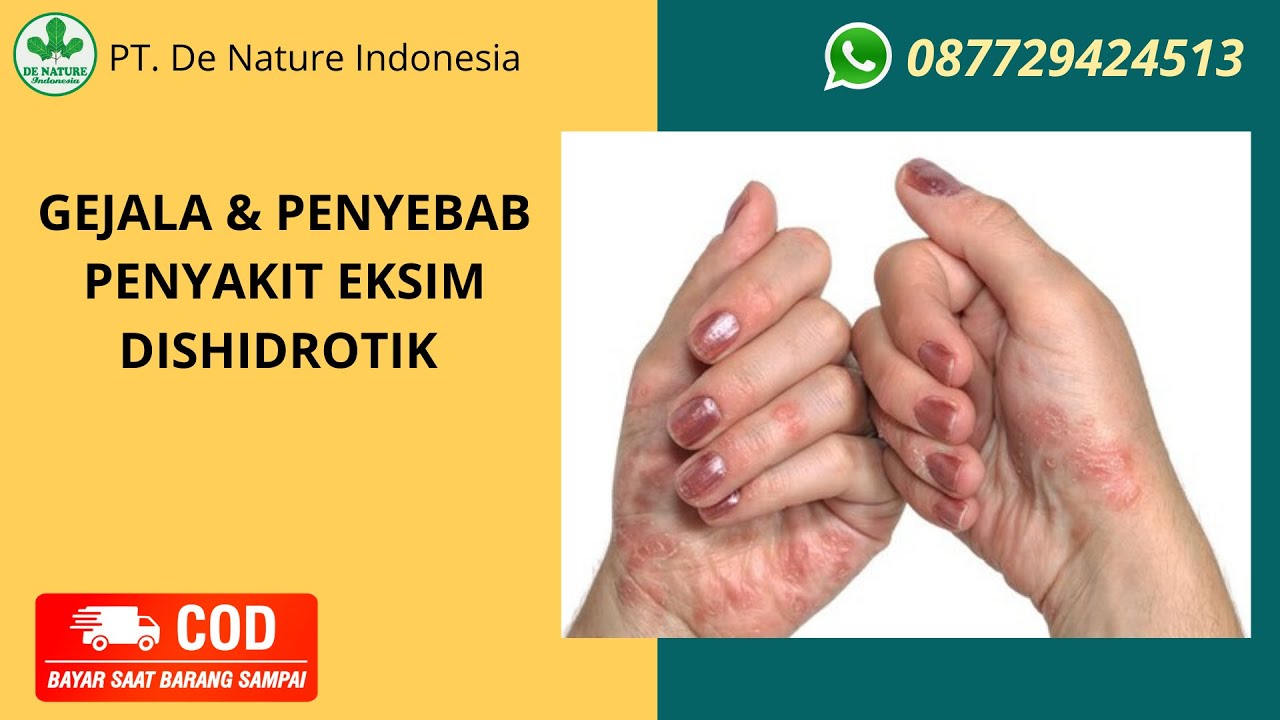 GEJALA PENYEBAB PENYAKIT EKSIM DISHIDROTIK DAN CARA TEPAT MENGOBATINYA ...