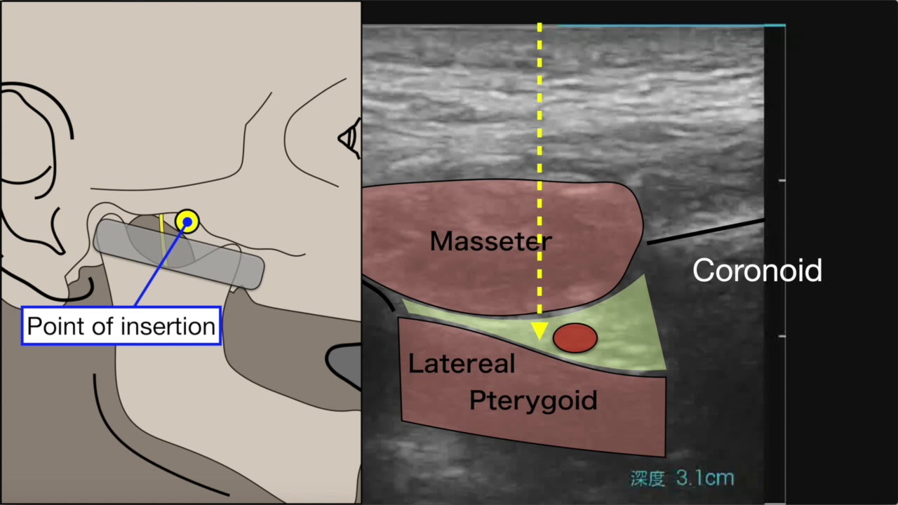 Maxillary / inferior alveolar nerve blocks for gnathoplasty - YouTube