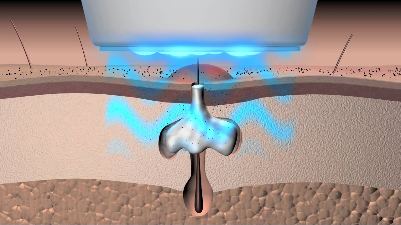 Watch how blue light goes beyond the surface to destroy acne-causing ...